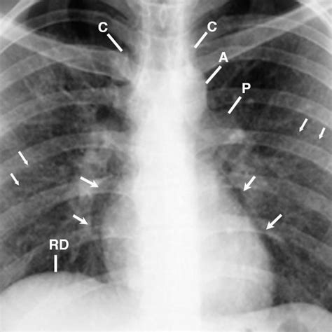 Why Does A Man Have Bilateral Nodular Densities On Chest Radiograph