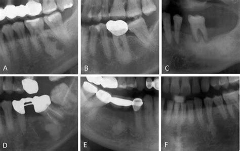 Condensing Osteitis Definition Causes Symptoms Diagnosis And Treatment