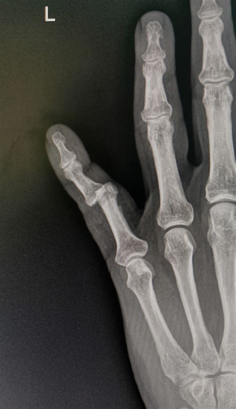 Finger Dislocation Surgeryazouz Hand Surgery