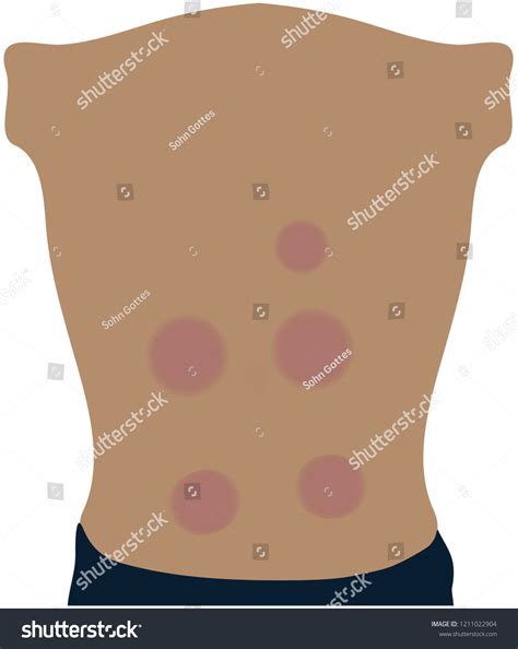 Cupping Therapy Marks Over 6 Royalty Free Licensable Stock