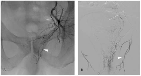 Prostate Artery Embolization Challenges Tips Tricks And Perspectives