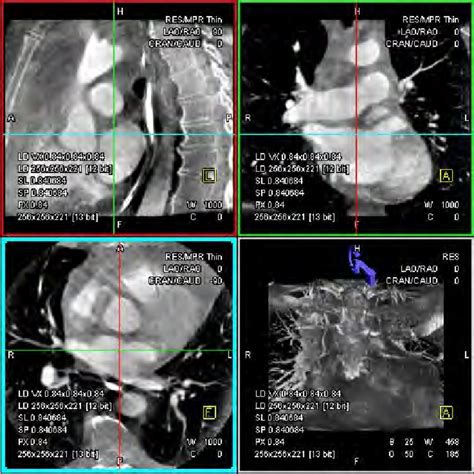 Cardiac Dynact Image The C Arm Ct Results Were Obtained With Syngo