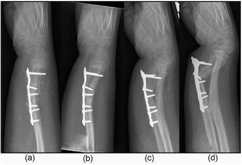 Congenital Pseudoarthrosis Of The Distal Radius Treated With Physeal Sparing Double Barrel