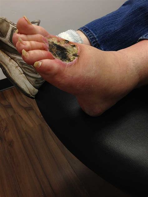 Pyoderma Gangrenosum Jan 3 2013