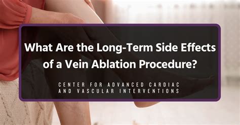 The Long Term Side Effects Of Vein Ablation Treatment
