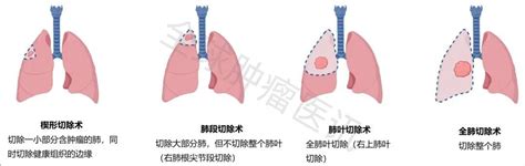国内外肺癌根治手术医院排名盘点 无癌家园