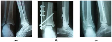 Gustilo Iii A Fracture Luxation Of The Ankle Weber C Ao Ota 44 C Download Scientific