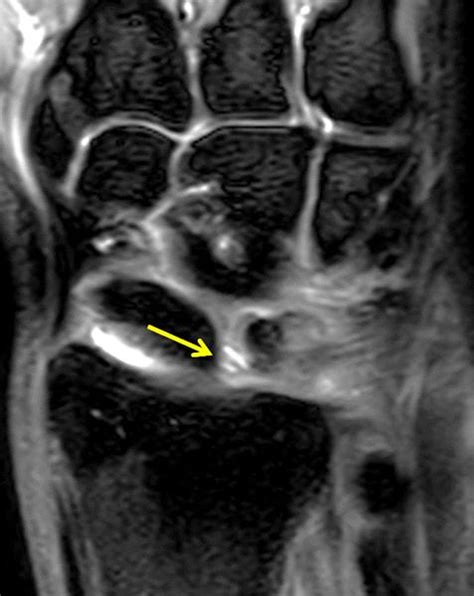 Wrist Ganglion Cysts Radsource