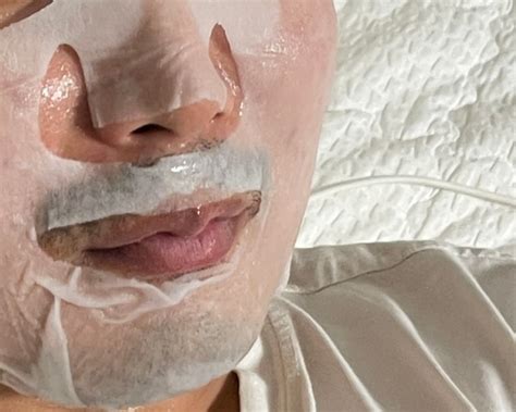 여드름 패인흉터 치료후기 5차 내돈내산 치료기록 네이버 블로그