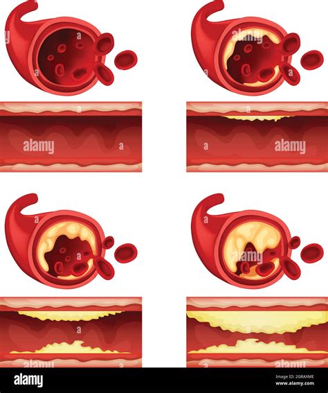 Diagram Showing Blood Clot Stock Vector Image And Art Alamy