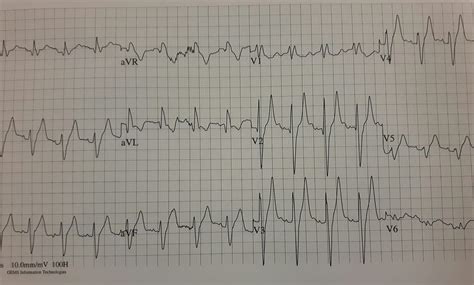 Called In The Field As Code Stemi But Rekgs