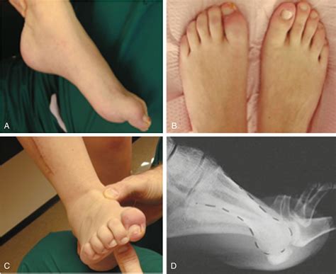 Types Of Lesser Toe Deformities At Bill Voigt Blog