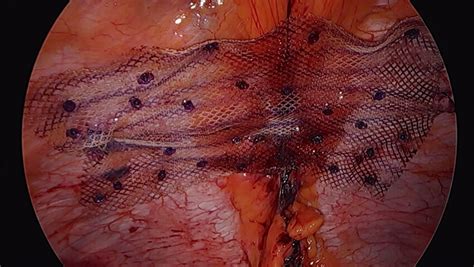 Final View Of The Repaired Umbilical Hernia Defect Via V Notes Download Scientific Diagram