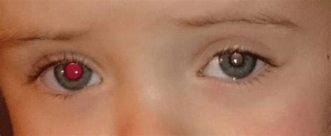 Detection Of Retinoblastoma In Smartphone Based App Resources Md Eyecare