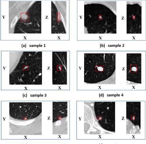 Figure From Lung Nodules Identification In CT Scans Using Multiple Instance Learning