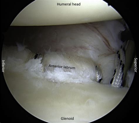Arthroscopic Labral Repair Using Knotless Suture Anchors In The Setting
