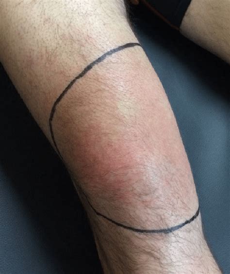 Diffuse Swelling Warmth Erythema And Tenderness Along The Download Scientific Diagram