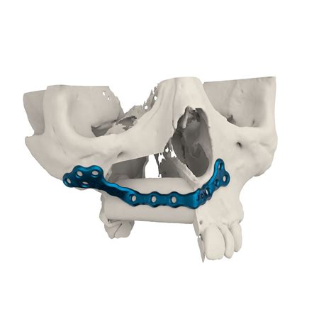 Expanding The Possibilities Of Maxillary Reconstruction