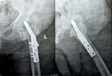 Femoral Neck Fracture X Ray