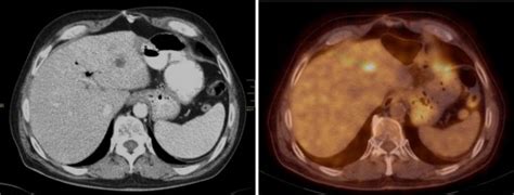 Is Asymptomatic Cholangitis No Clinical Signs Normal Bood Tests A Common Feature Of A Whipple