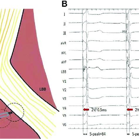 A Schematic Diagram Of Continuous Pacing At Low Output 2 V 05 Ms Download Scientific