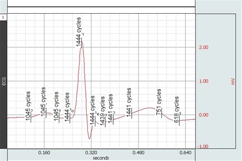 Ecg Cardiology Automated Ecg Analysis Research Biopac