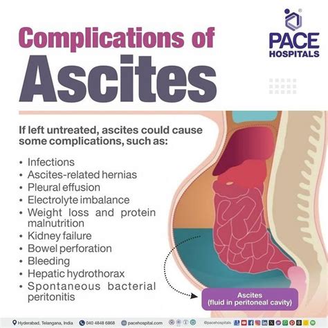Pancreatic Ascites