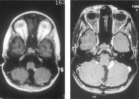 Figure 3 From Treatment Of Intracranial Ependymoma By Surgery Alone