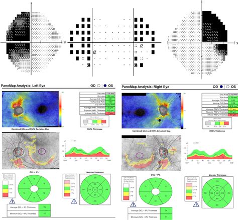 Optic Nerve Degeneration In Pituitary Adenoma Opth