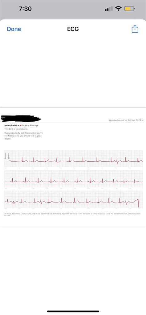 No Compensatory Pause R Readmyecg