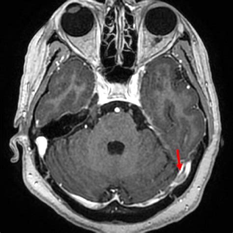 Axial Enhanced 3 Dimensional Spoiled Gradient Echo Image Showing A