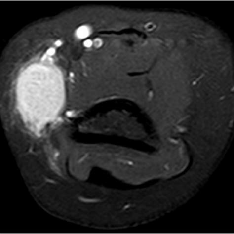 Enlarged Right Epitrochlear Lymph Node