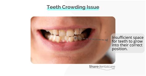 Teeth Crowding Issue Share Dental Care