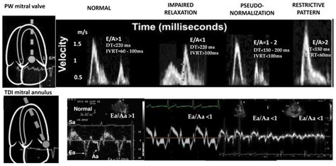 Additional Prognostic Value Of Tissue Doppler Evaluation In Patients