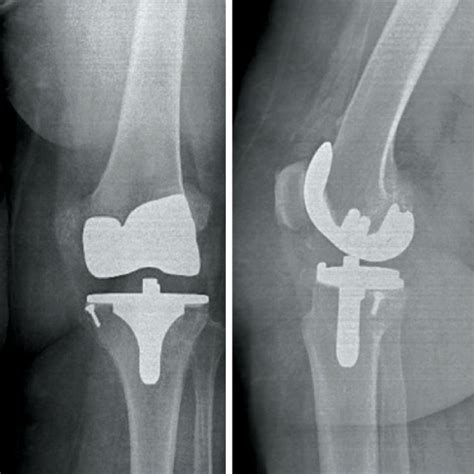 Pdf Bone Cement With Screw Augmentation Technique For The Management Of Moderate Tibial Bone