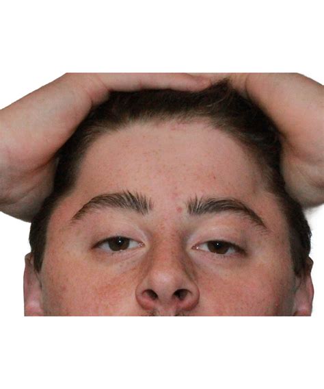 Before And After Archive Kansas Cleft And Craniofacial Center