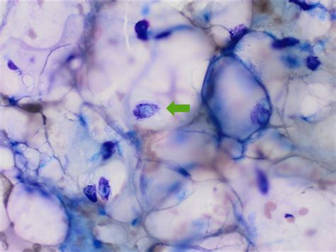 Dog Lipoma Vs Liposarcoma