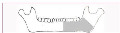 Unilateral Ramus Body Mandibulectomy At Right Or Left X