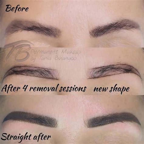 Laser Removal Of Permanent Makeup Tania Bhangoo Permanent Makeup