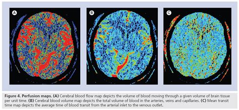 Role Of Ct Perfusion Imaging In The Diagnosis And Treatment Of Va