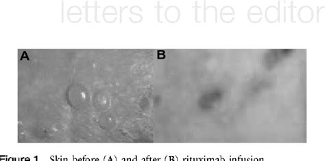Figure From A New Approach On Bullous Pemphigoid Therapy Semantic Scholar