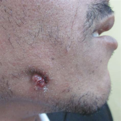 Dental Sinus Tract Dermalive