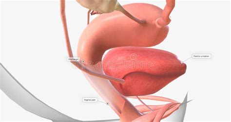 Gonorrhea Is A Sexually Transmitted Infection Caused By The Bacterium