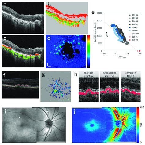 Ps Oct In The Posterior Eye Ad Ps Oct Of A Patient With Late Stage Download Scientific