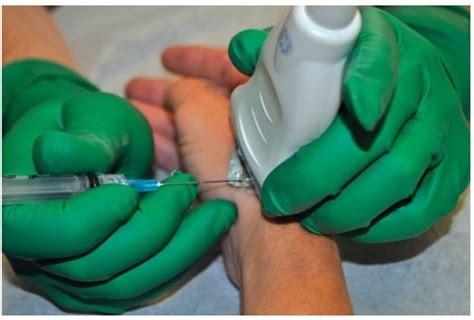 Carpometacarpal Joint Injection Wikism