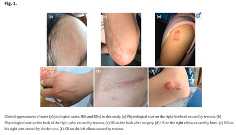 대구켈로이드흉터치료 효과가 없는 것 같다면 네이버 블로그