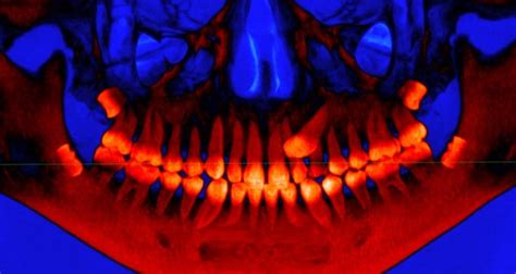 Why Do Humans Still Have Wisdom Teeth Evolution Explains
