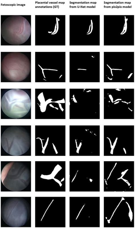 placental vessel segmentation using pix2pix compared to u net