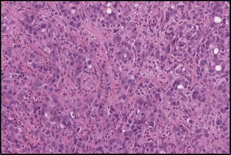 High Power Photomicrograph Showing Metastatic Cholangiocarcinoma Download Scientific Diagram