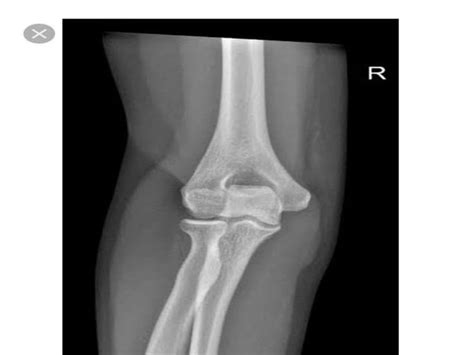 1 Upper Limb Radiograph Presentationpptx